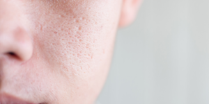 Open Pores: Causes, Treatments, Results & Prevention